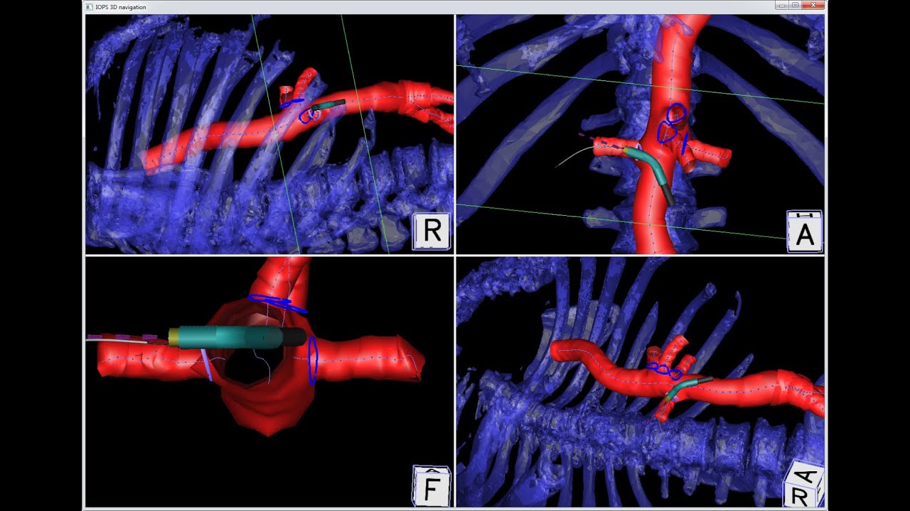 Centerline Biomedical - YouTube