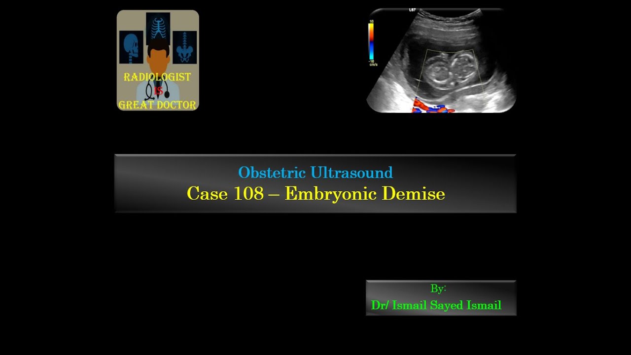 Ultrasound Case 108 - Embryonic Demise - YouTube