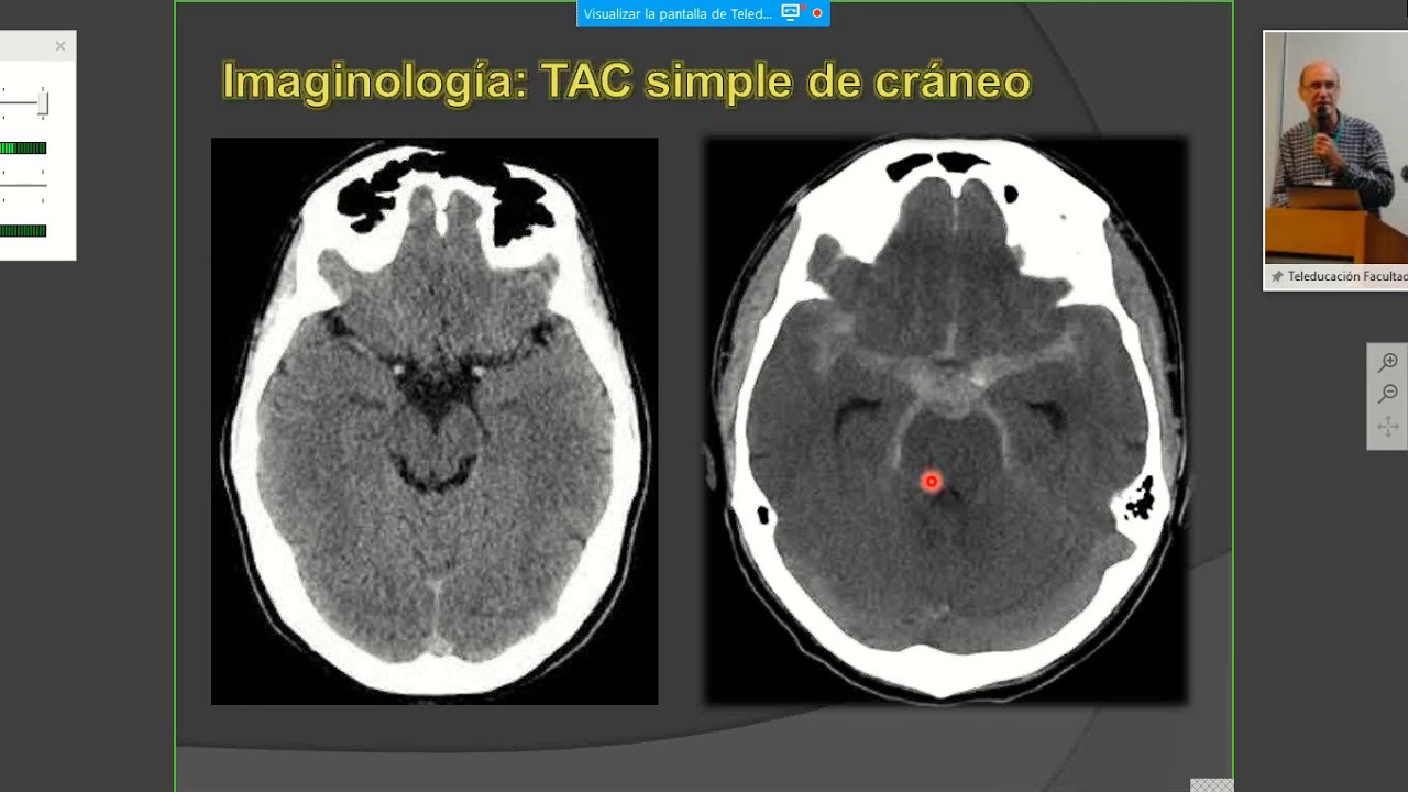 12 Hemorragia Subaracnoidea aneurismatica - YouTube