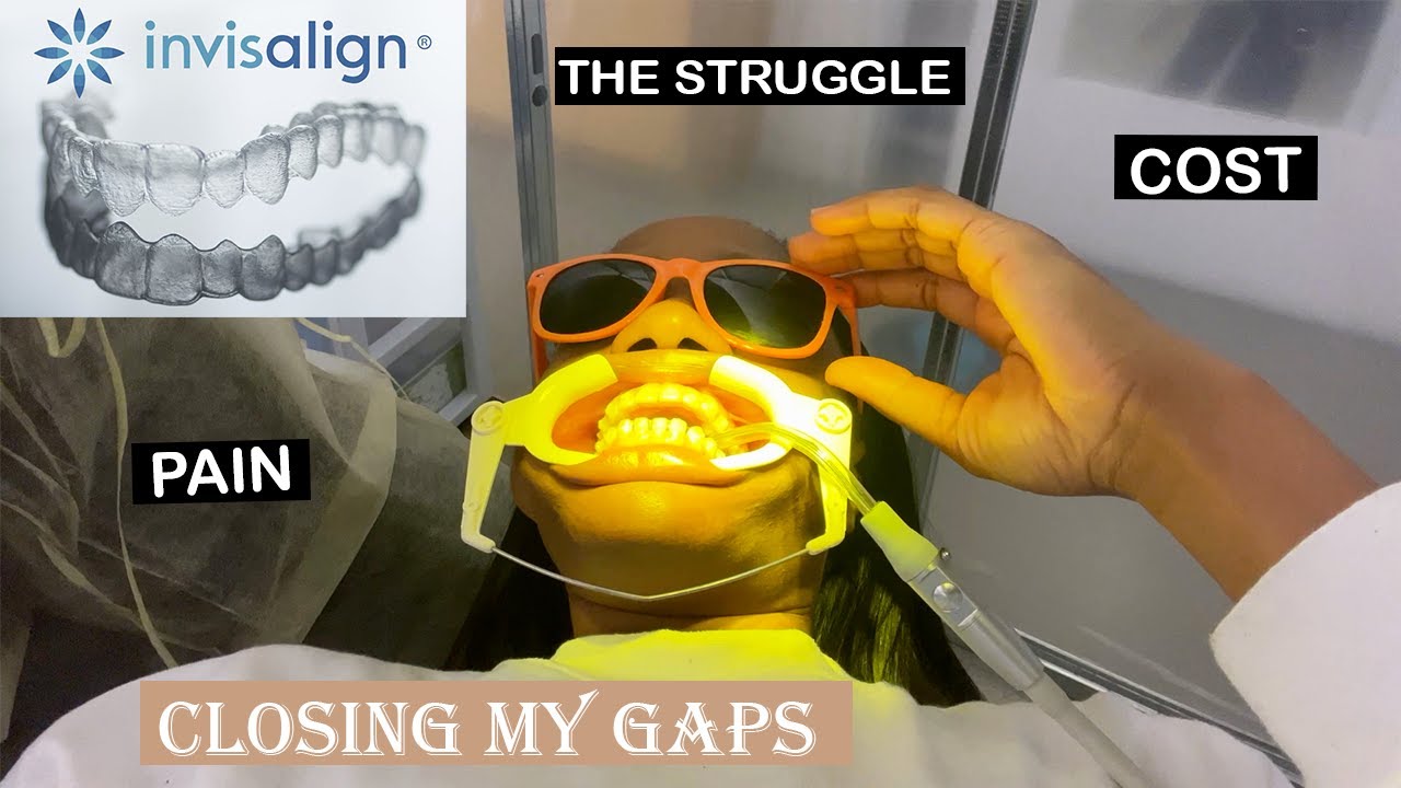 My Invisalign Journey #1 (Closing My Gaps) || First Scan, First Tray ...