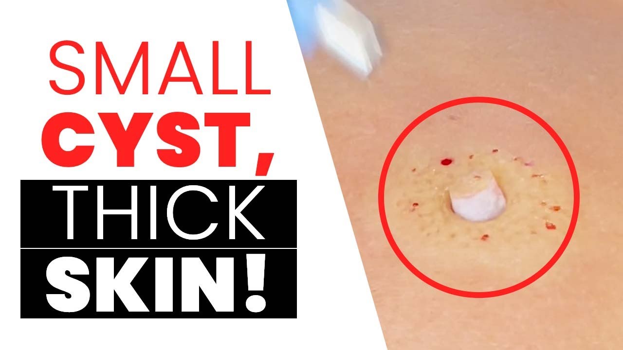 SMALL CYST, THICK SKIN! - YouTube