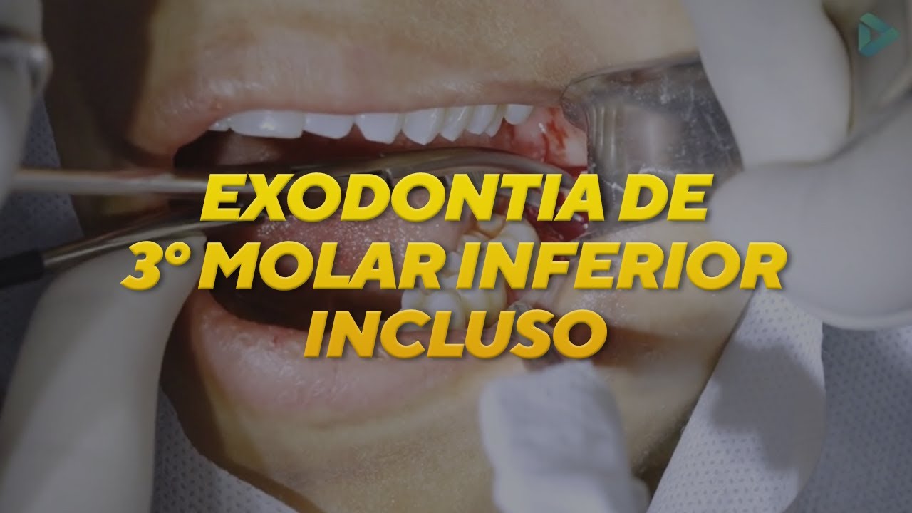 EXODONTIA DE TERCEIRO MOLAR INCLUSO | CIRURGIA - YouTube