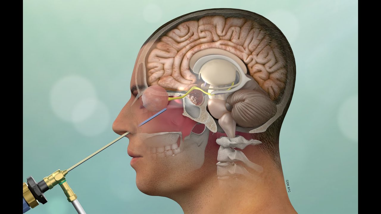ENDOSCOPIC TRANSNASAL TRANSPHENOIDAL EXCISION OF PITUITARY MACROADENOMA ...