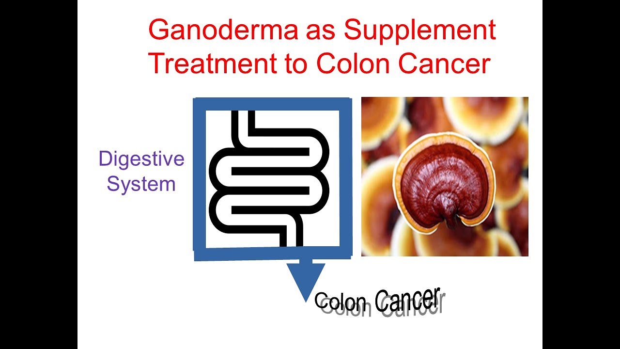 Webinar : Immune System - Colon Cancer - YouTube