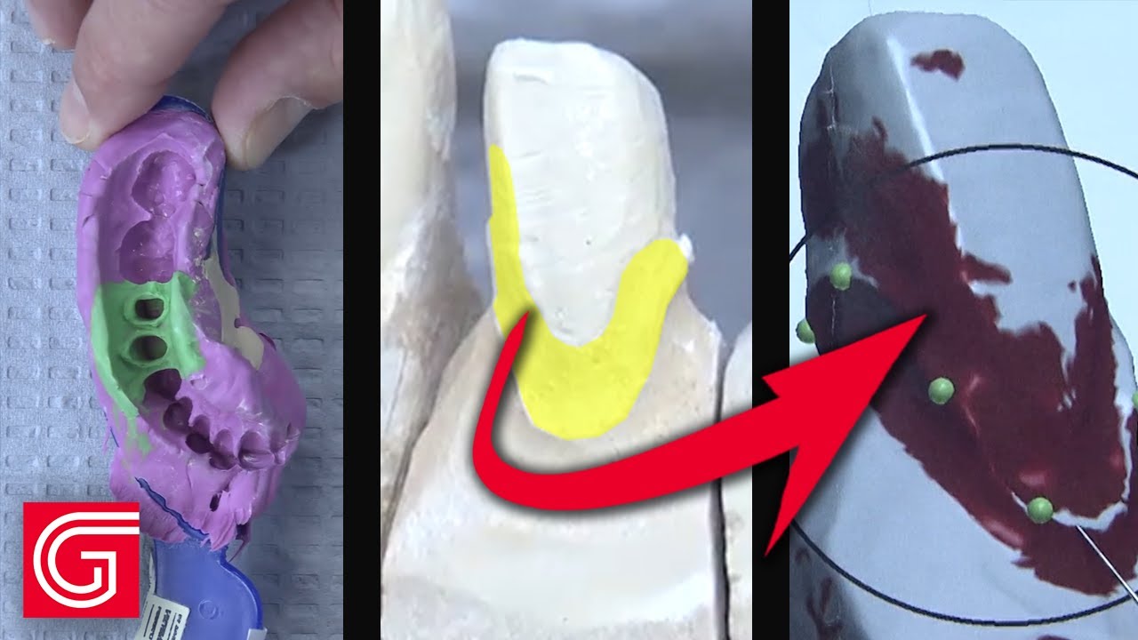 How Do You Avoid #ToothPreparation Undercuts? #shorts - YouTube