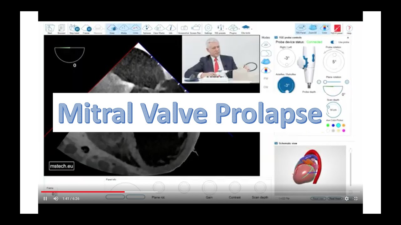 TEE simulator - Mitral Valve Prolapse - YouTube