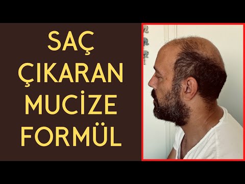 Saçlarım Yeniden Çıktı | Saç Çıkaran MUCİZE FORMÜL !! Saç Dökülmesine Kesin Çözüm