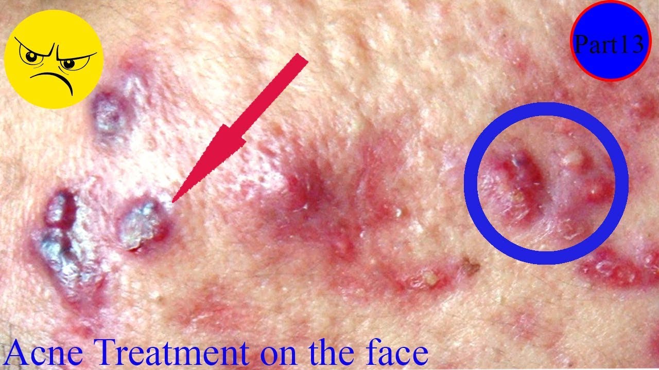 Cystic Acne, Pimples And Blackheads Extraction, Acne Treatment On Face ...