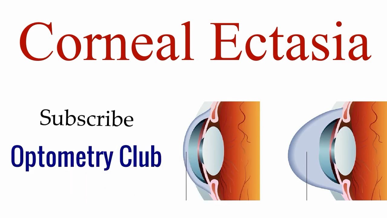 Corneal Ectasia Introduction - Optometry Club - YouTube