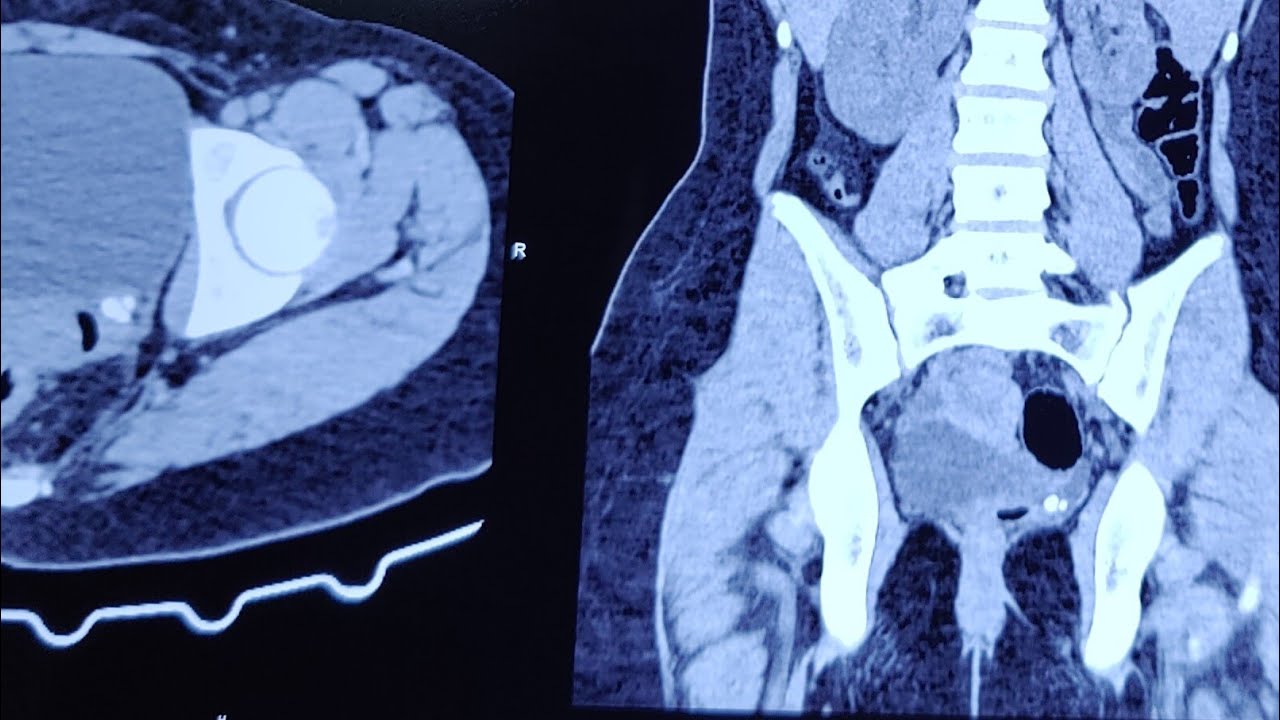 Calcification post endoscopic treatment for VUR masquerading sd VUJ ...