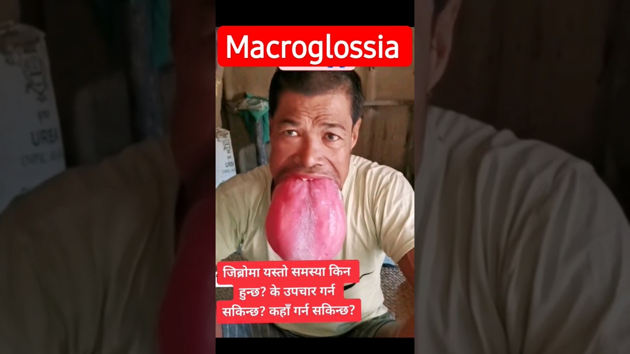 Macroglossia. #Dr.DevrajShrestha #dental #dentist #dentistry - YouTube