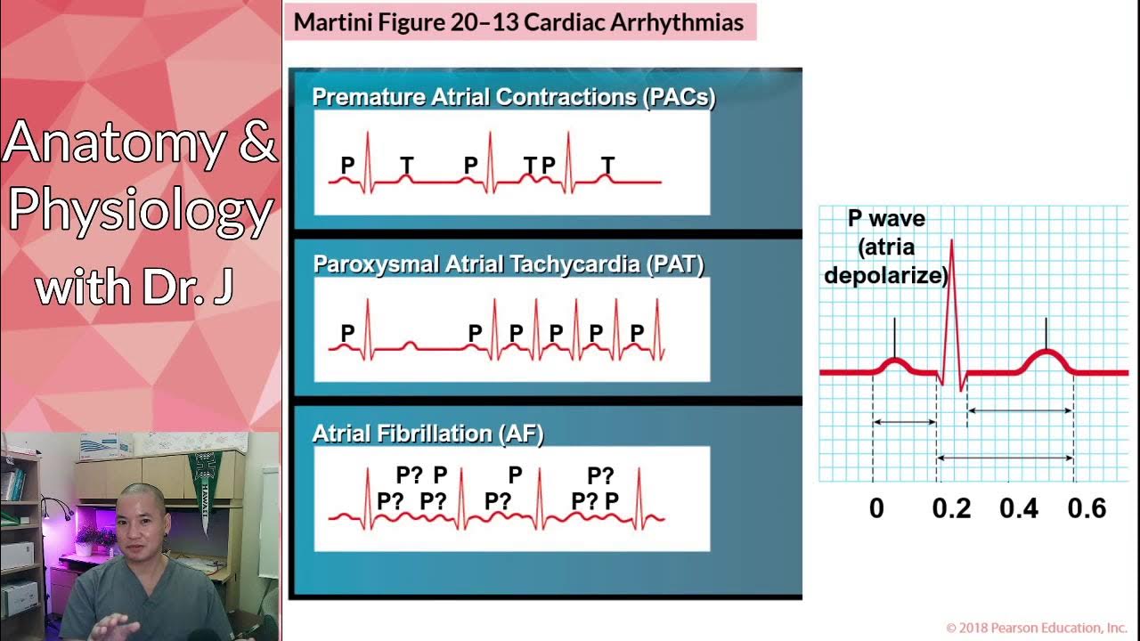 PHYL 142 | Cardiac | Basic Abnormal ECG Patterns - YouTube