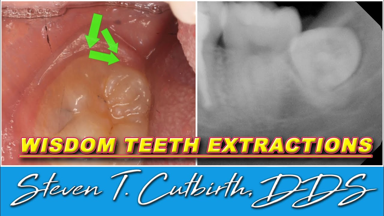4 Impacted Wisdom Teeth Extractions - Dental Minute with Steven T ...
