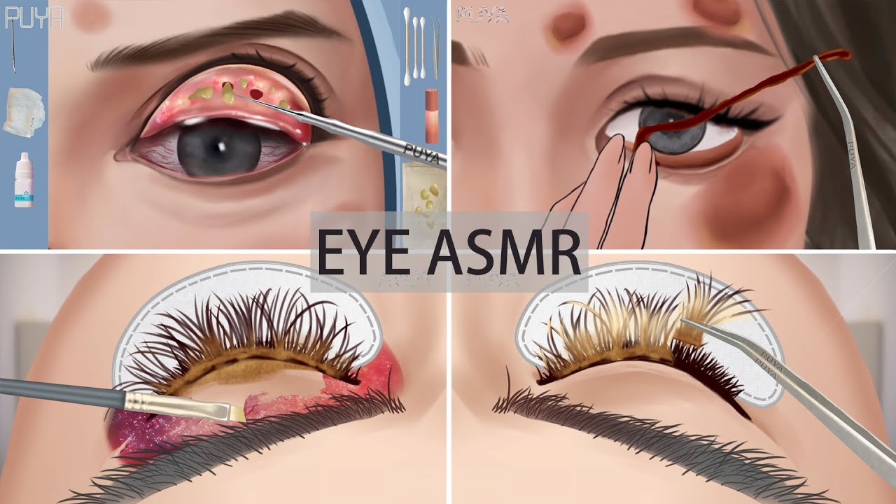 ASMR eye stone removal animation |Acne Removal Skin Care|Full Blackhead ...