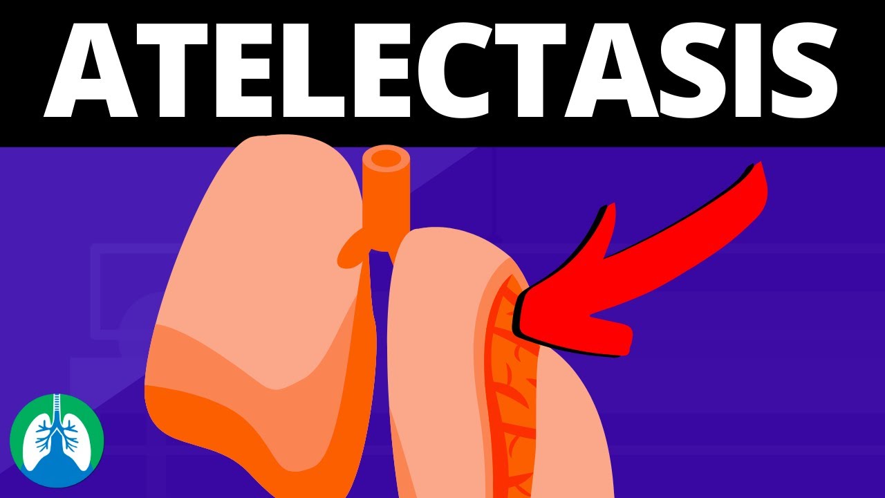 Atelectasis (Medical Definition) | Quick Explainer Video - YouTube