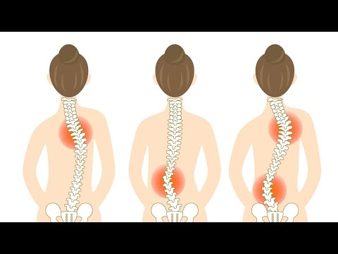 Skolioz üçün idman (skolioz egzersizleri)scoliosis exercise