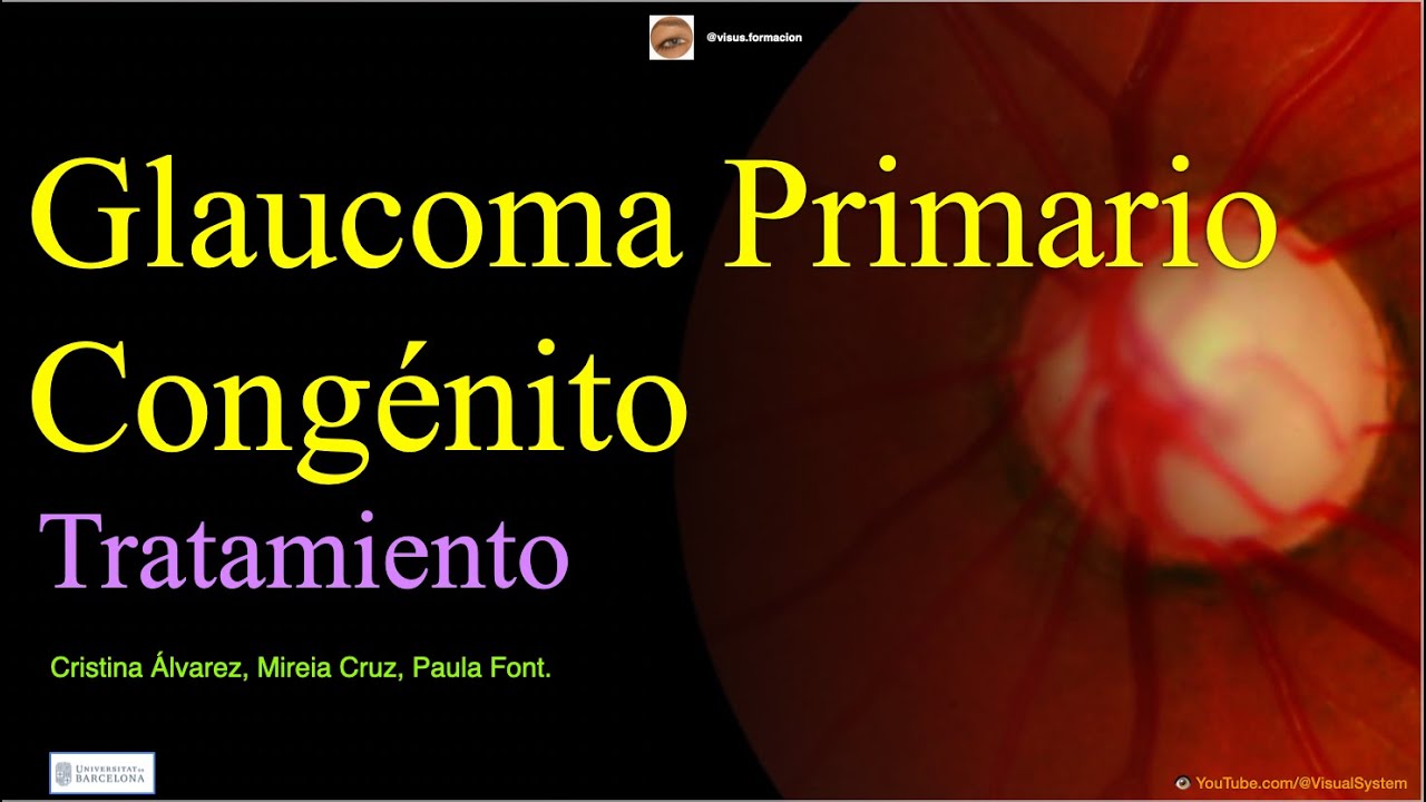 Tratamiento del Glaucoma Primario Congénito. - YouTube