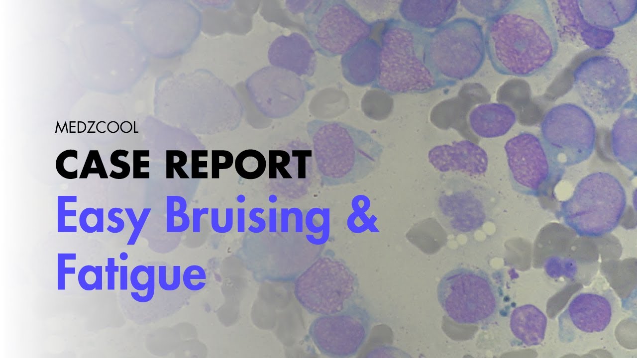 Easy Bruising & Fatigue - Case Report - MEDZCOOL - YouTube