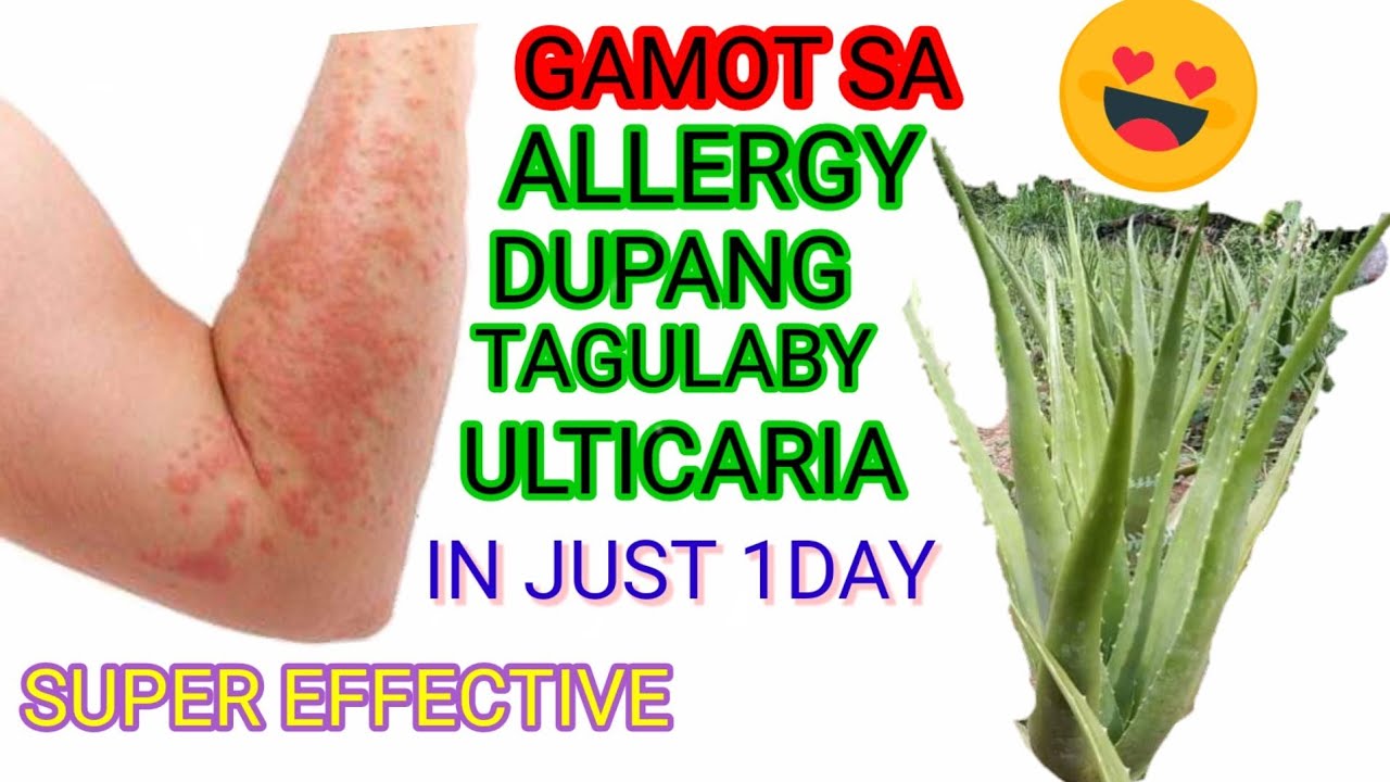 GAMOT SA TAGULABAY/DUPANG/ALLERGY/KATI-KATI/ULTICARIA/IN JUST 1DAY ...