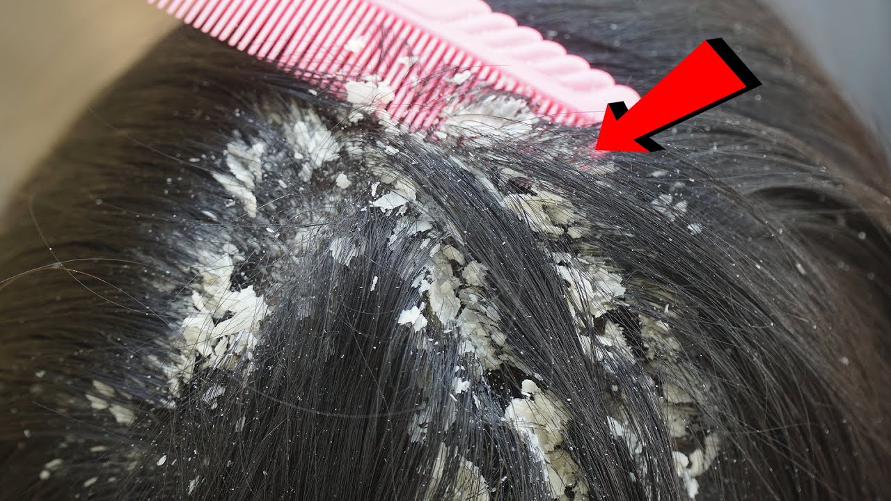 Hair Combing Dandruff / Cialina Channel 1139 - YouTube