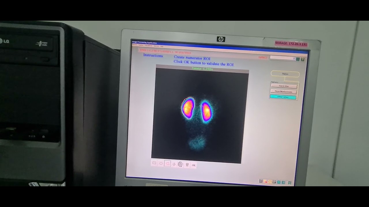 Proceso de una gammagrafia renal pediátrica - YouTube