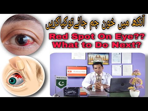 Red spot in eye | Red dot eyes | subconjunctival hemorrhage treatment ...