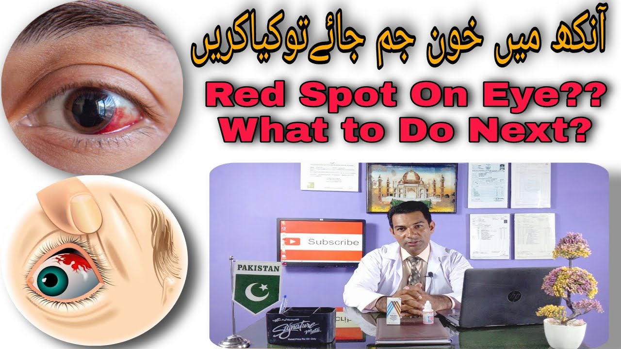 Red Spot In Eye Red Dot Eyes Subconjunctival Hemorrhage Treatment red-spot-in-eye-red-dot-eyes-subconjunctival-hemorrhage-treatment