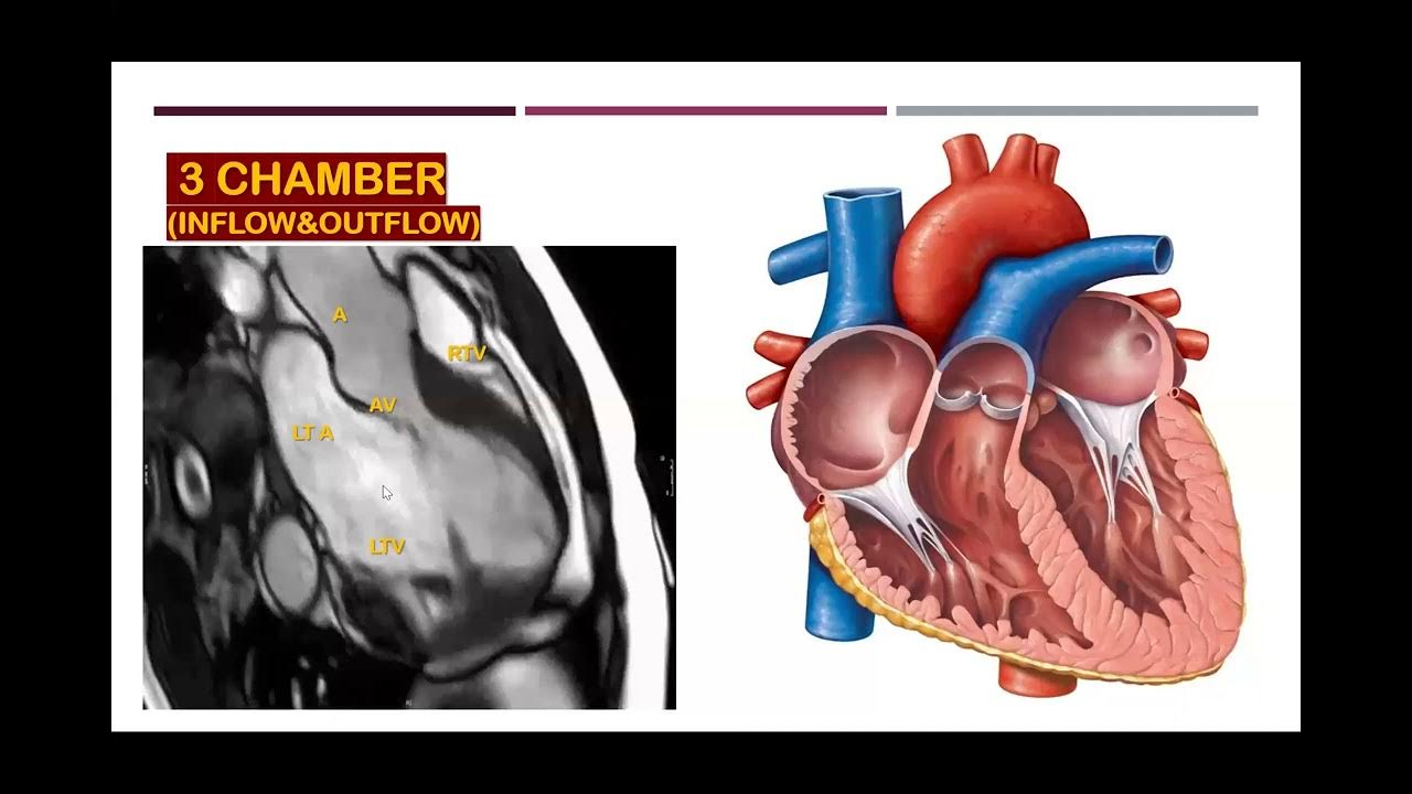 cardiac MRI part 2 👉 cardiac view (4 chambers - 2 chambers -short axis - 3 chambers -LVOT) - YouTube
