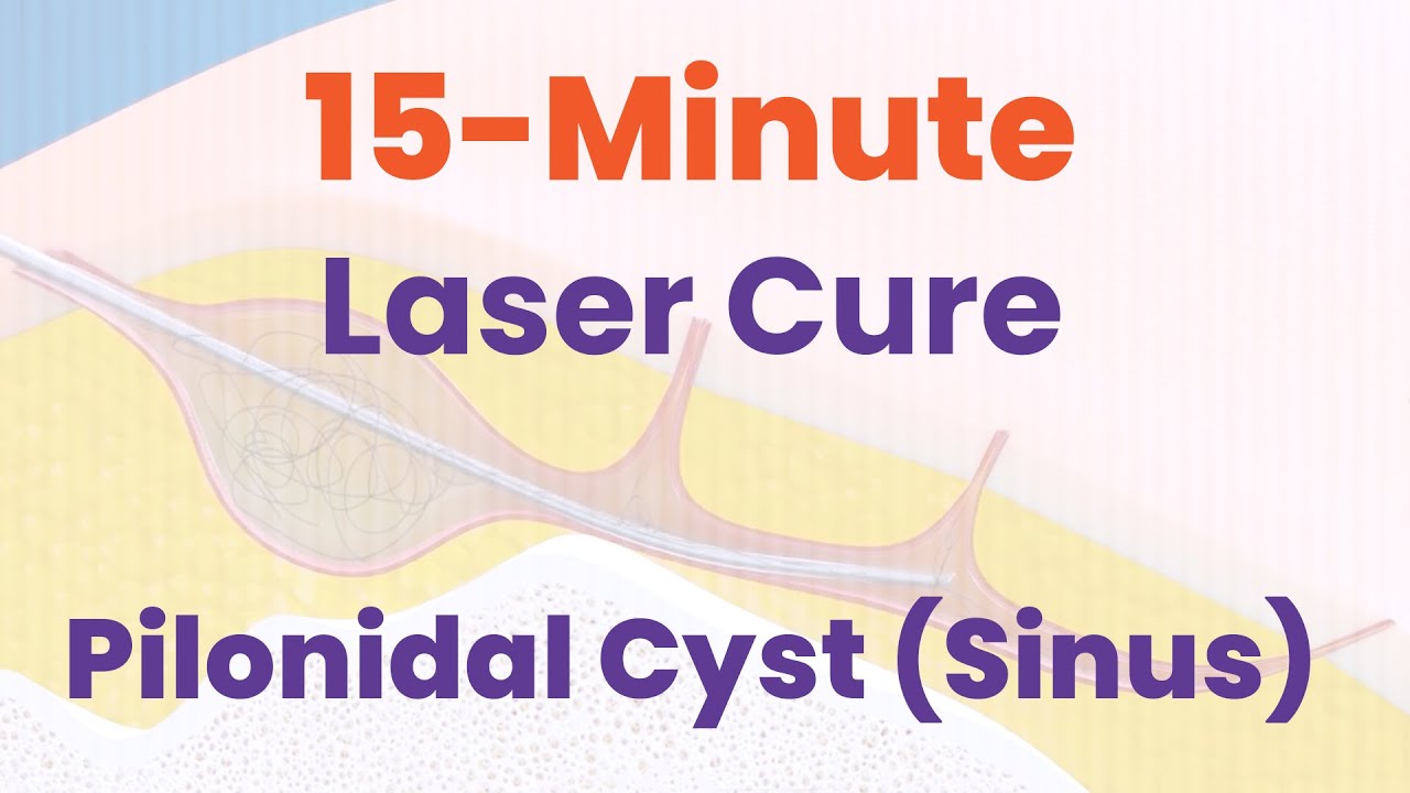 15-Minute Laser Treatment for Pilonidal Cyst (Sinus) – Minimal Pain ...