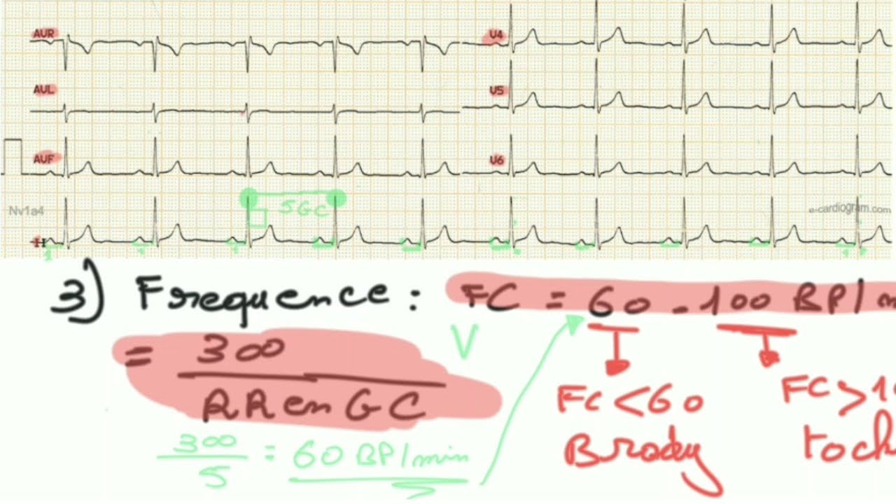 ECG de A à Z : ECG normal (Rythme et Frequence) - YouTube