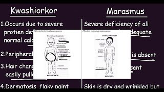 Diferença entre Kwashiorkor e Marasmo