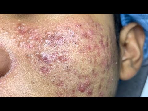 Acne Treatment #0001 - YouTube