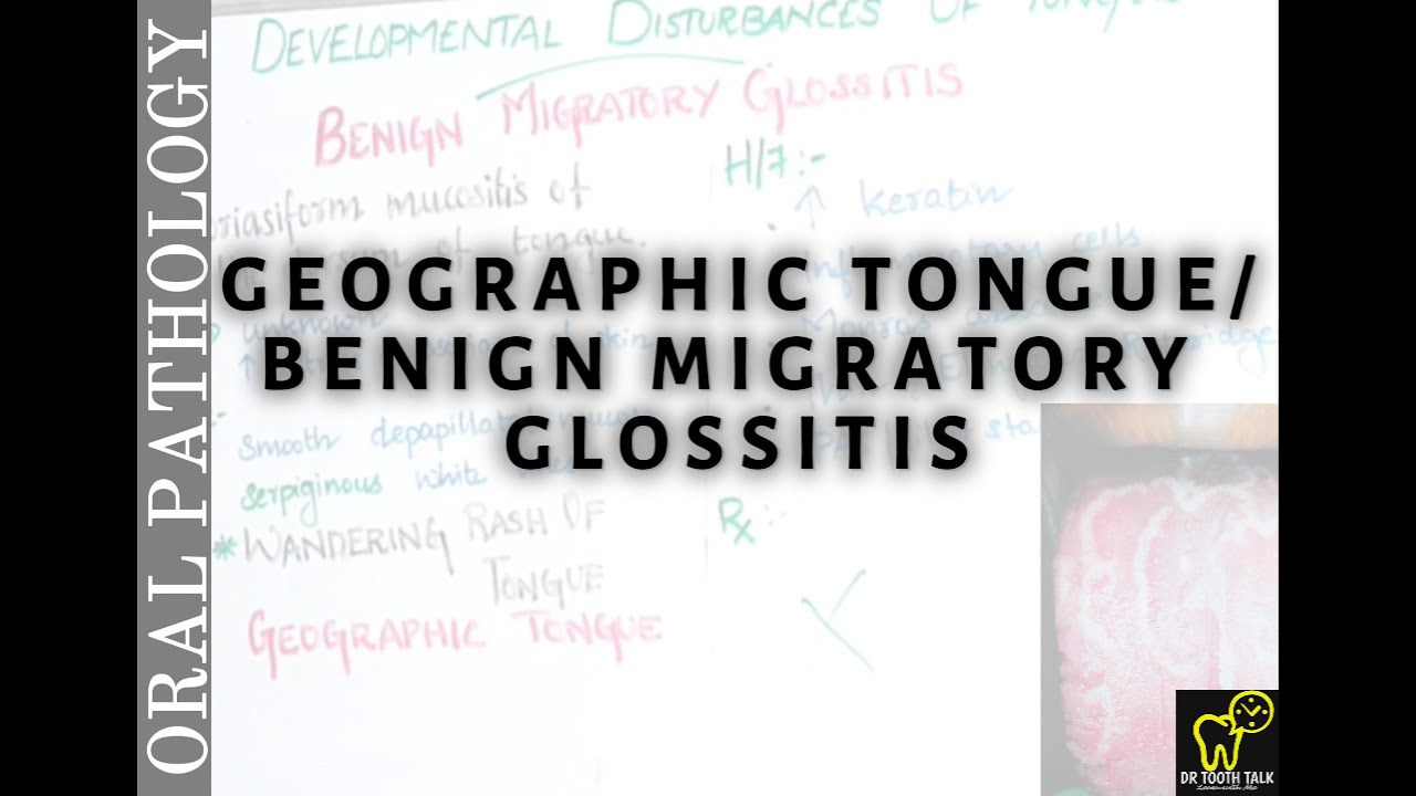 GeographicTongue | Benign Migratory glossitis| Developmental ...