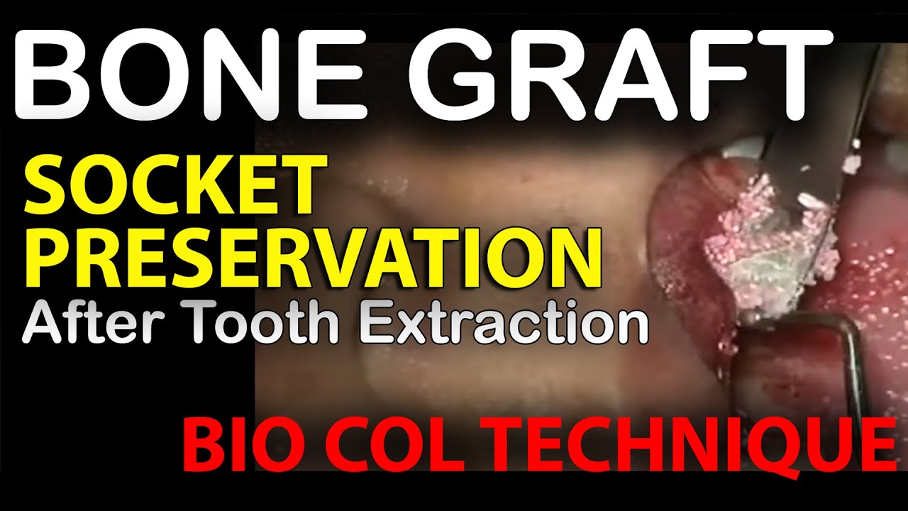 Bone Graft and Socket Preservation after Tooth Removal, BIO COL ...