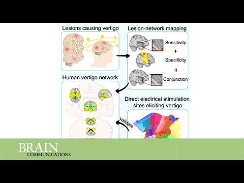 A vertigo network derived from human brain lesions and brain ...