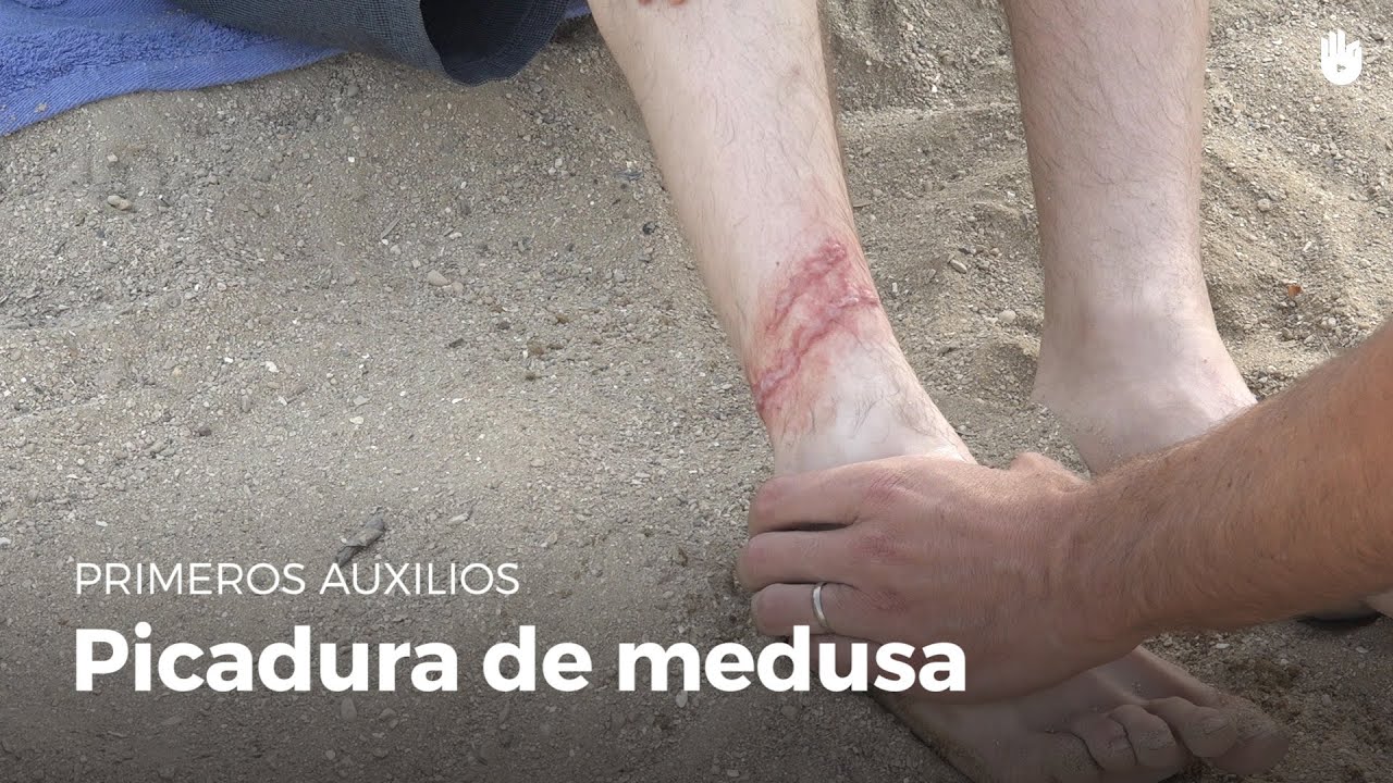Primeros auxilios : Picadura de medusa | Primeros auxilios - YouTube