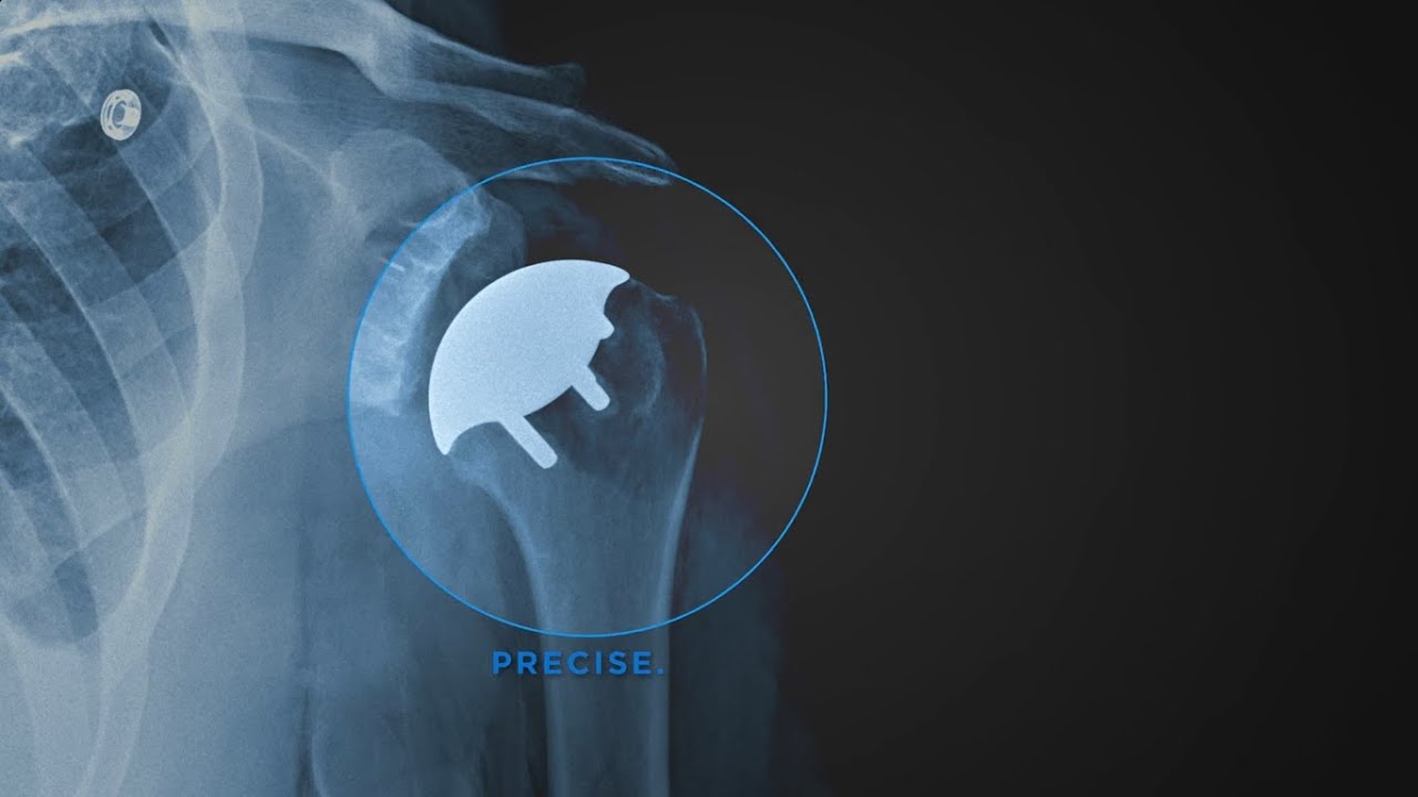 Catalyst’s Archer™ CSR Total Shoulder System Animation - YouTube