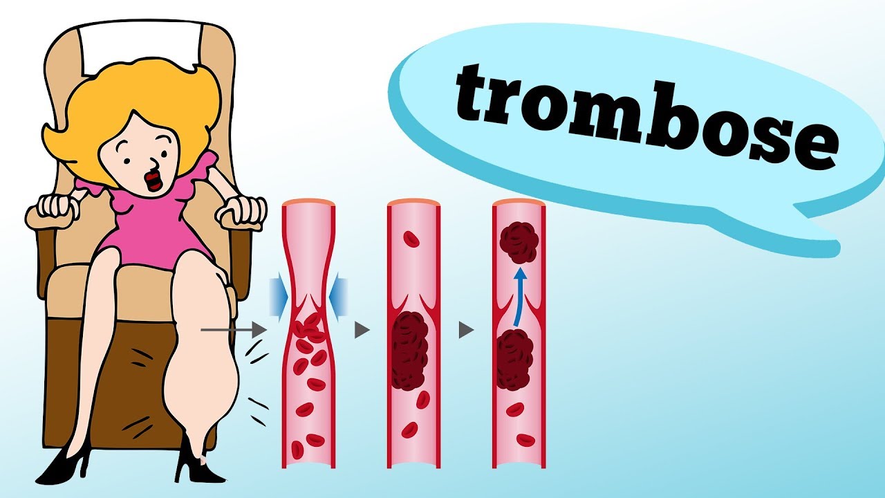QUAIS OS SINTOMAS E CAUSAS DA TROMBOSE? - YouTube