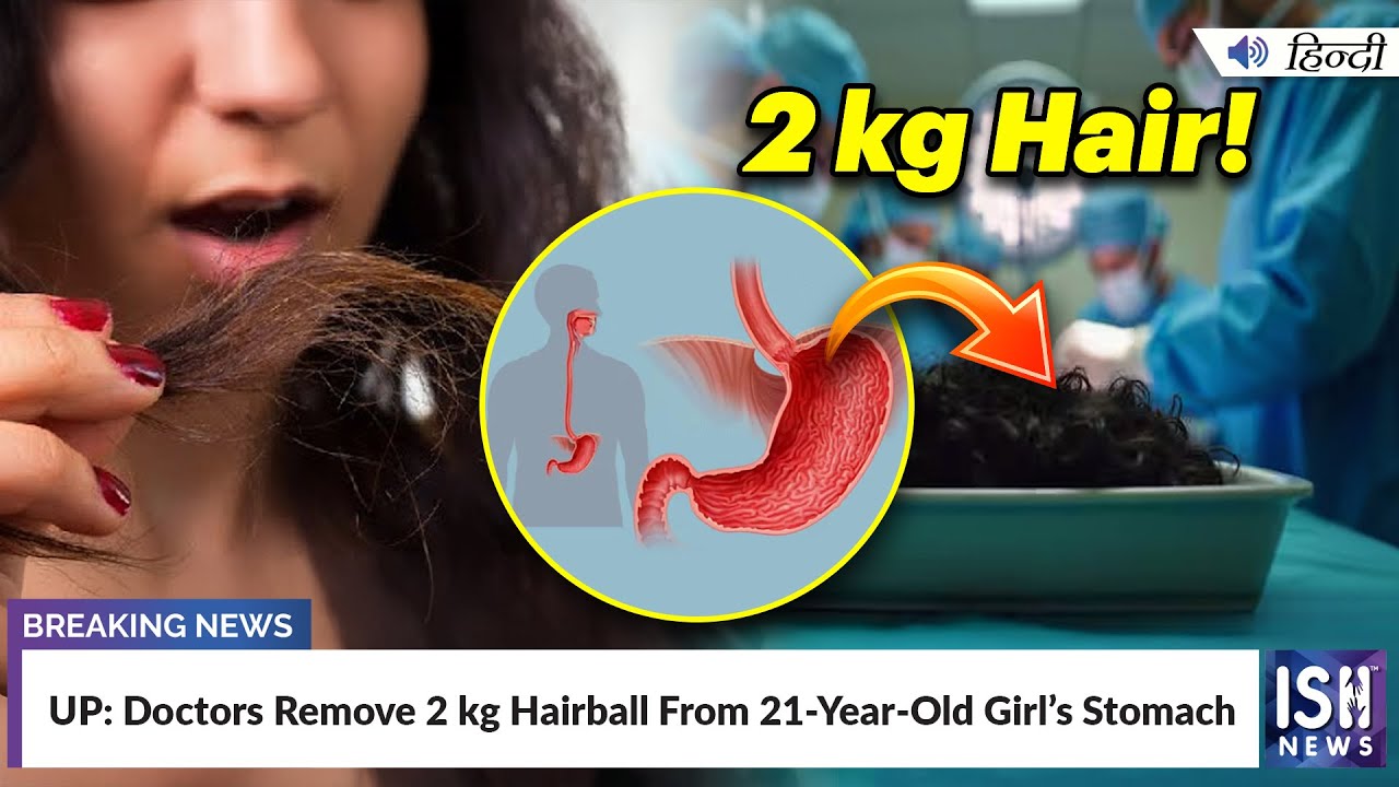 UP: Doctors Remove 2 kg Hairball From 21-Year-Old Girl’s Stomach | ISH ...