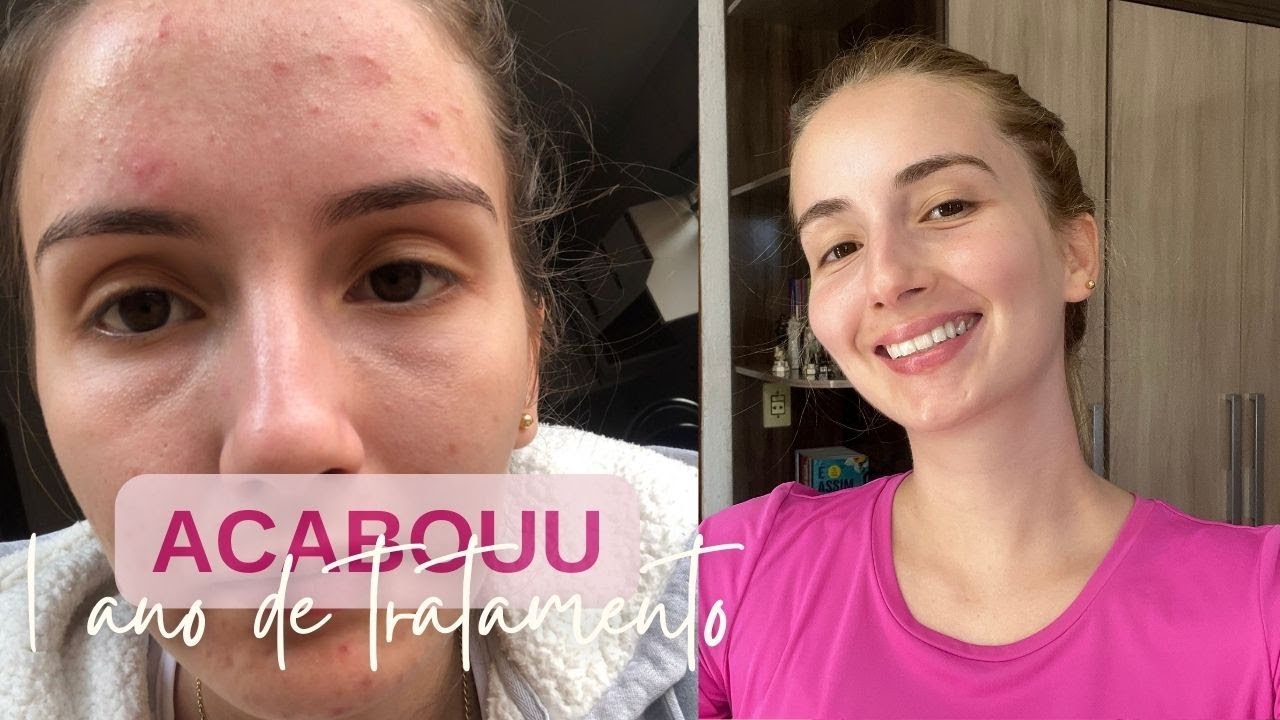 DIÁRIO DO ROACUTAN: 12 meses de tratamento - YouTube