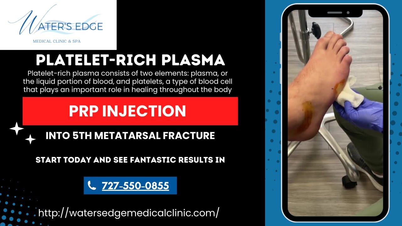PRP injection into 5th metatarsal fracture - YouTube