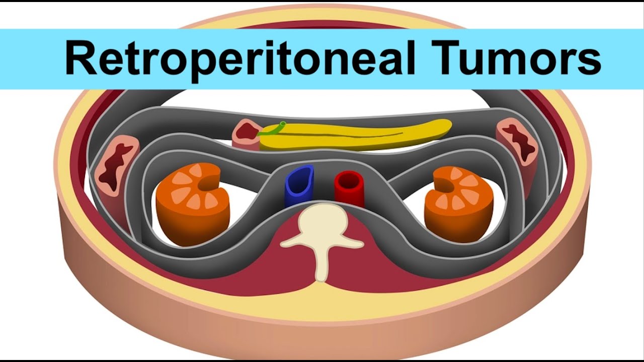 Retroperitoneal Tumors by ASM Minds Team - YouTube