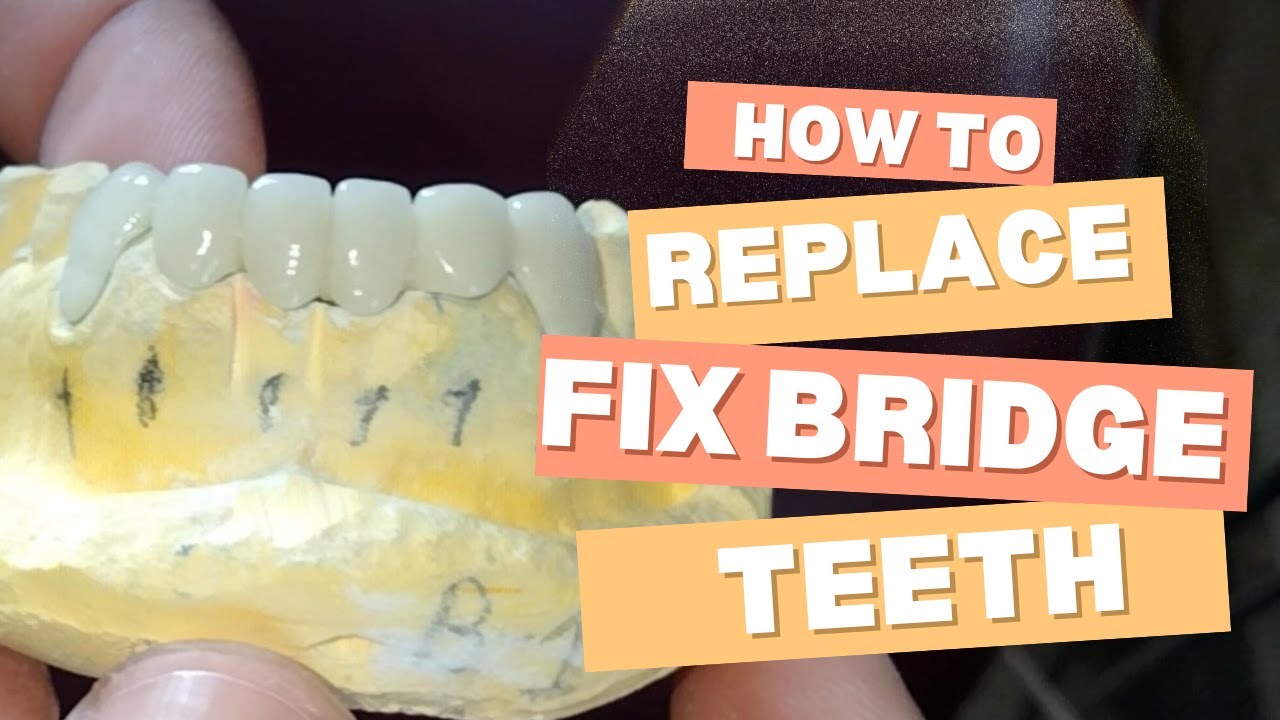 How to replace lower teeth crown bridge | tooth replacement | fix teeth ...