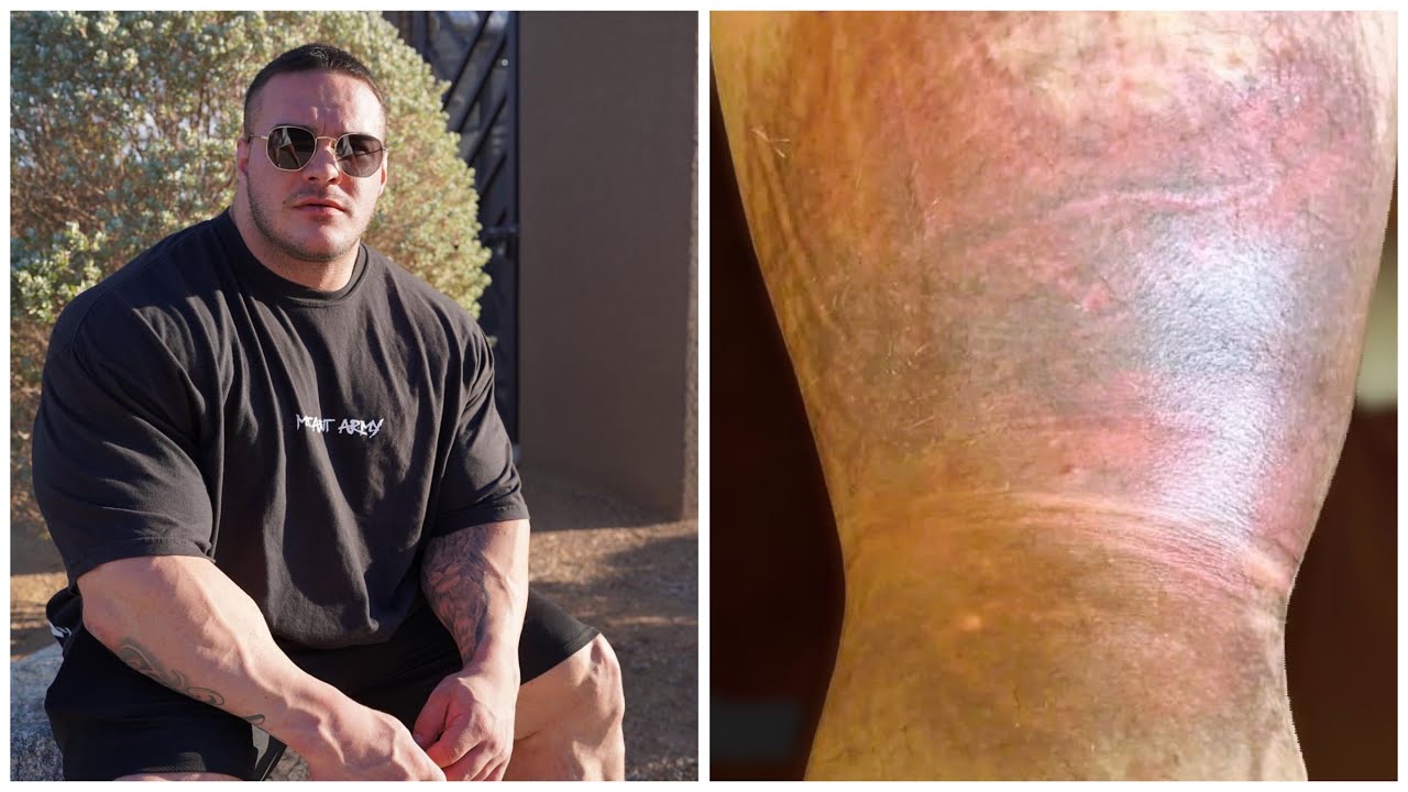 Nick Walker Injury Made him Exit Mr Olympia 2023 - YouTube