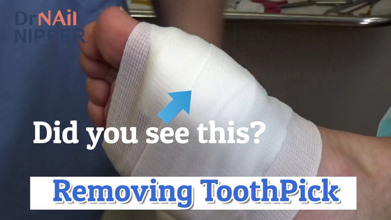 Toothpick in the Toe [Saturday] (2020) - YouTube