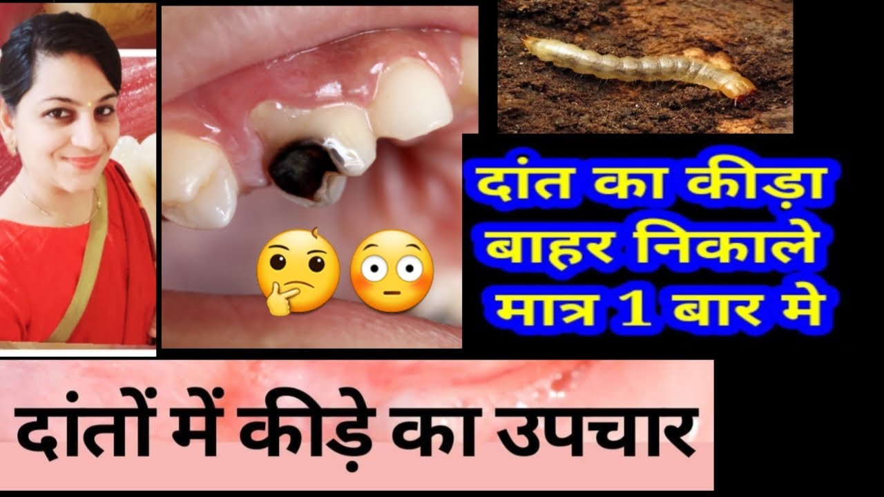 दांत का कीड़ा कैसा होता है?Dant me kida lag Jaye toh kya karna chahiye ...
