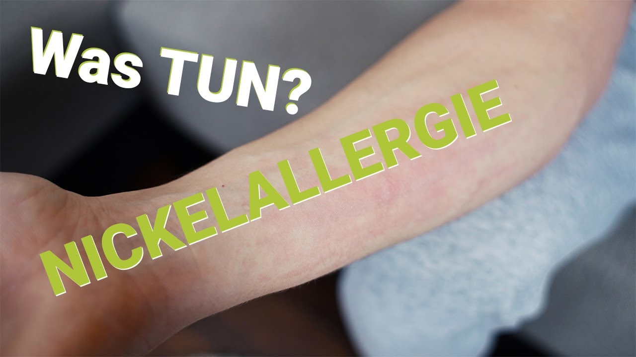 Wie erkennst du eine Nickelallergie? - YouTube