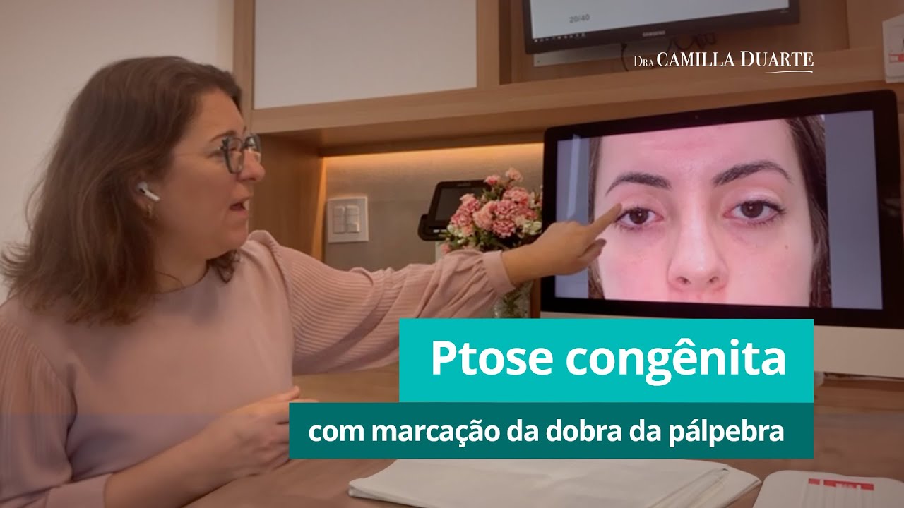 Ptose Congênita com marcação da dobra da pálpebra - YouTube