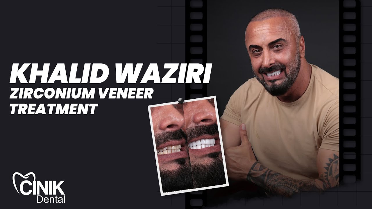 Khalid Waziri | Zirconium Veneer Treatment Journey | Cinik Dental - YouTube