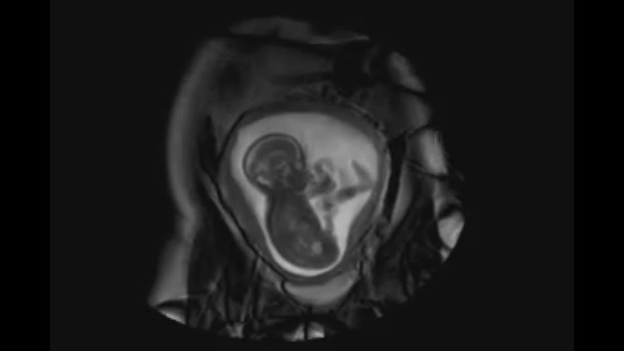 LIVE Unborn Baby Moving Inside Womb YouTube live-unborn-baby-moving-inside-womb-youtube